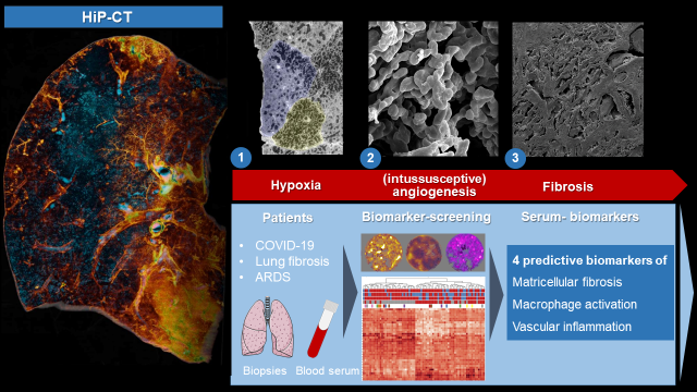 Long COVID and pulmonary fibrosis better understood thanks to innovative techniques